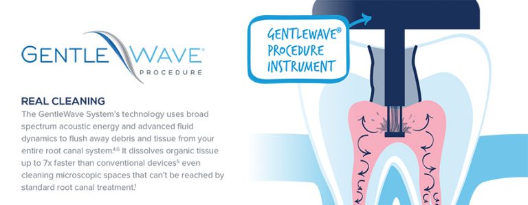The GentleWave® System by Sonendo - Vancouver Dental Surgery